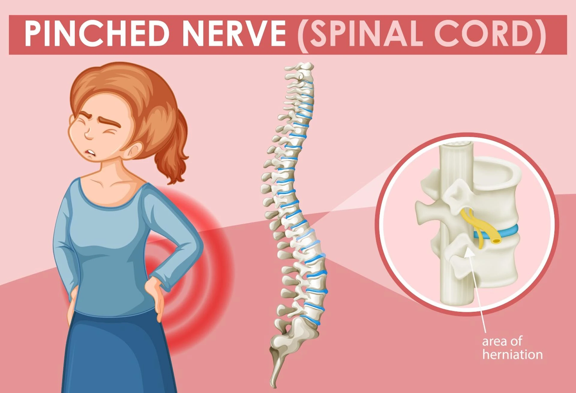 WHAT CAUSES A PINCHED NERVE & HOW CHIROPRACTIC CAN HELP - TheOmniBuzz