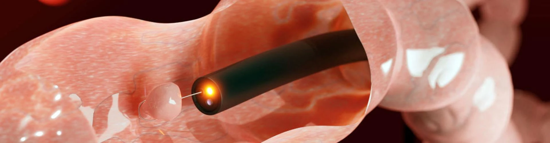 Understanding Colonoscopy Costs in Singapore - TheOmniBuzz
