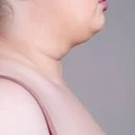 Causes and Treatment options for Fat Neck - TheOmniBuzz